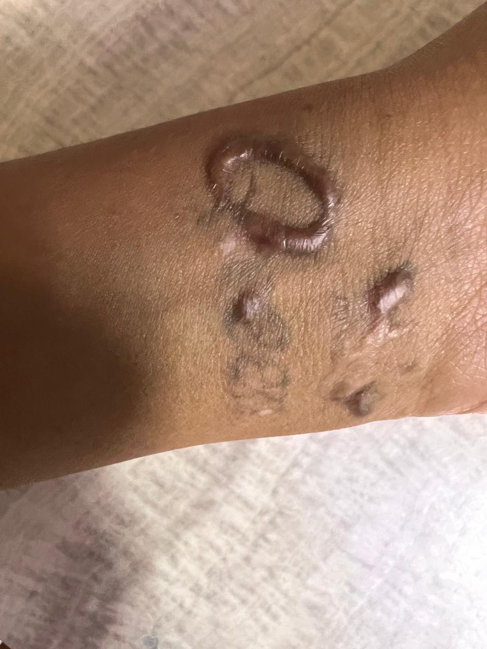 Hypertrophic scars and keloids - Jalad Aesthetic Clinic